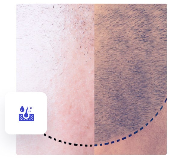 What is FUE Hair Transplant | 8 Stages of the FUE explained